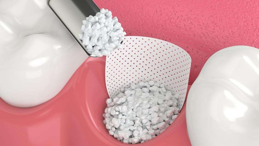 Understanding Dental Bone Grafting: Elk Groves Guide to Restoring Bone ...